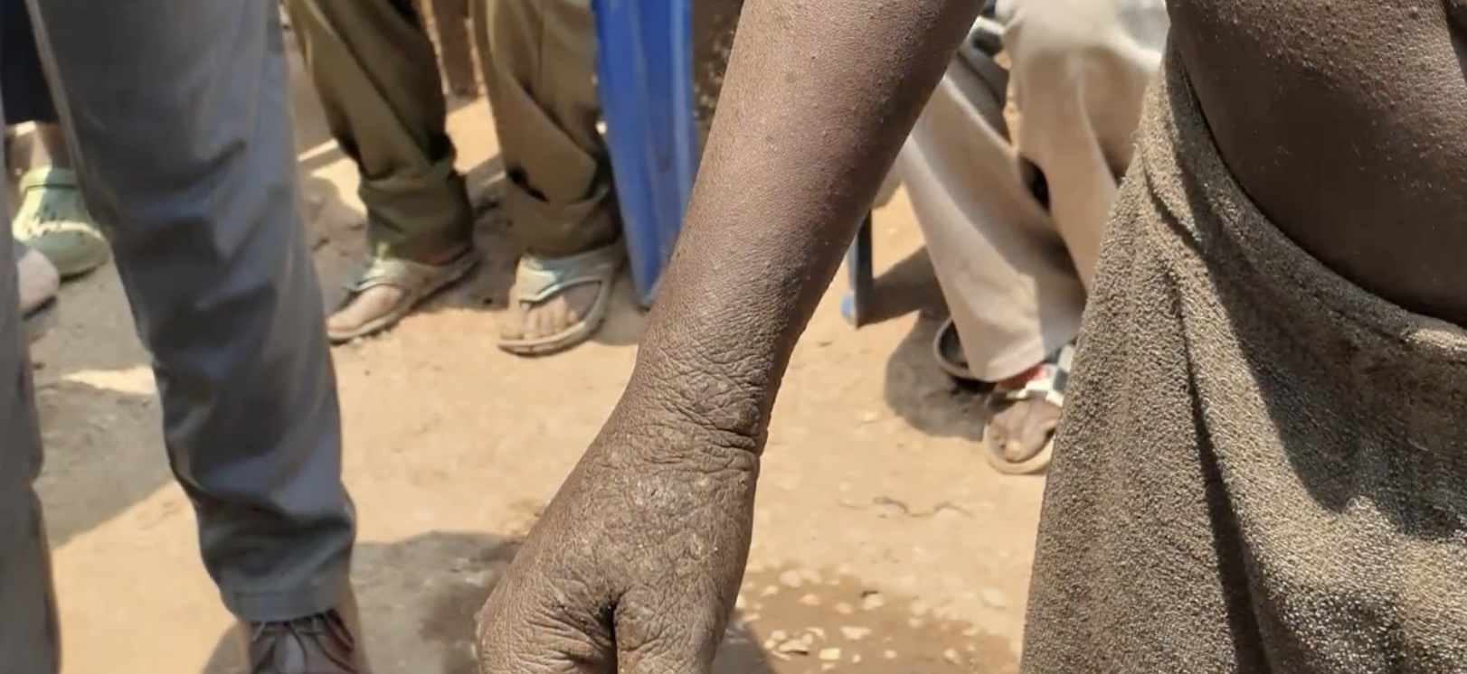 Cobalt mining in DRC causes childhood illnesses, reproductive health ...